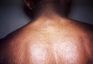 Skin rashes, a major sign of coronavirus infection - New study - DNB ...